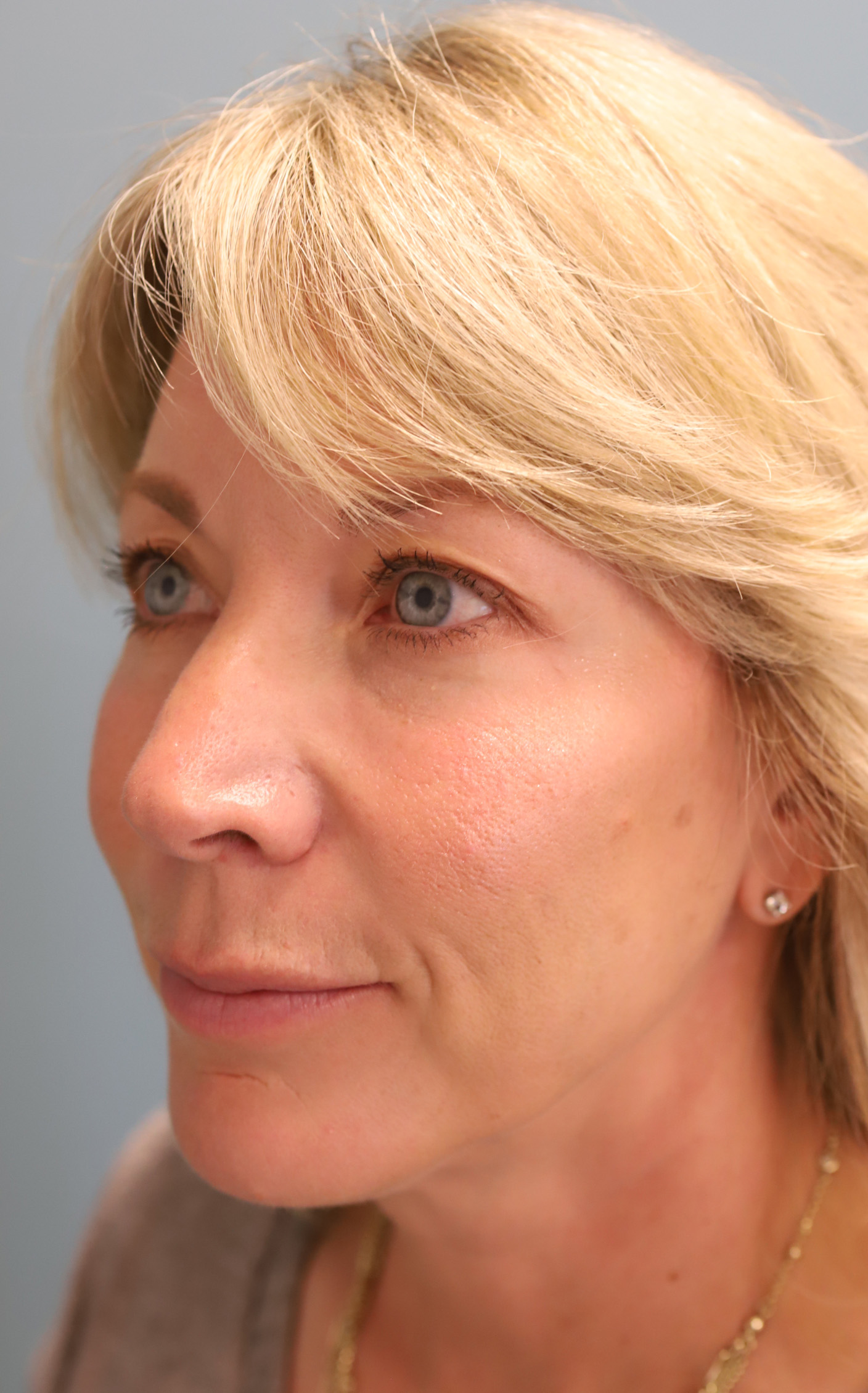 Knoxville Eyebrow Lift Cosmetic Procedure - The Lucas Center Knoxville