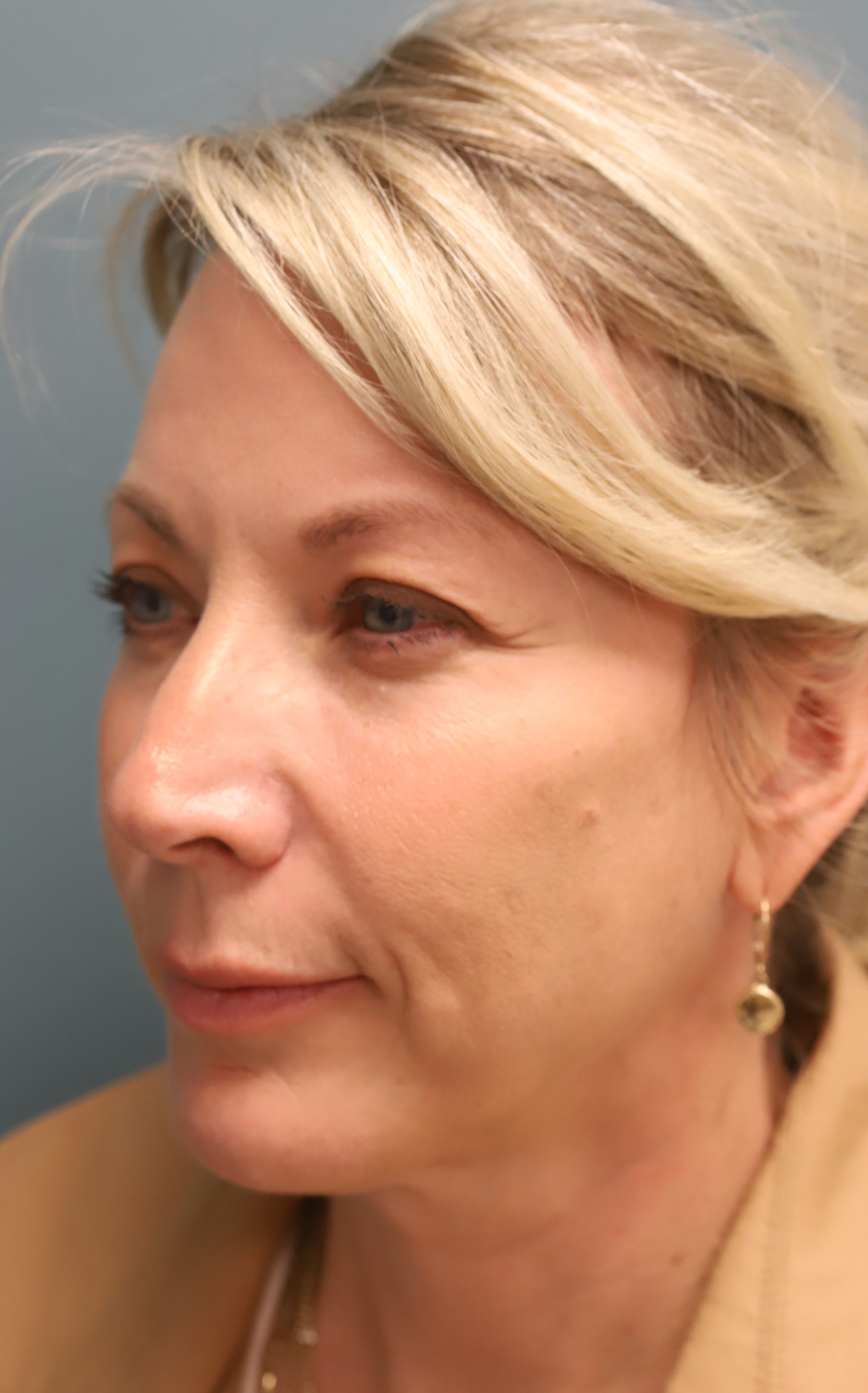 Knoxville Eyebrow Lift Cosmetic Procedure - The Lucas Center Knoxville